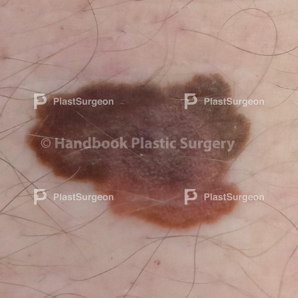 Types of Melanoma – PlastNurse – Learn Surgical Nurse Procedures